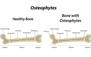 Osteophyte (Bone Spur) Causes, Symptoms, and Treatment - Massage and ...
