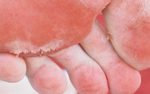 Three Common Foot Problems – Symptoms and Treatment - Massage and Spa Blog